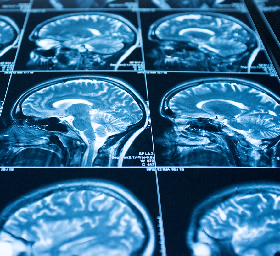 What is neurology? | Neurological Foundation